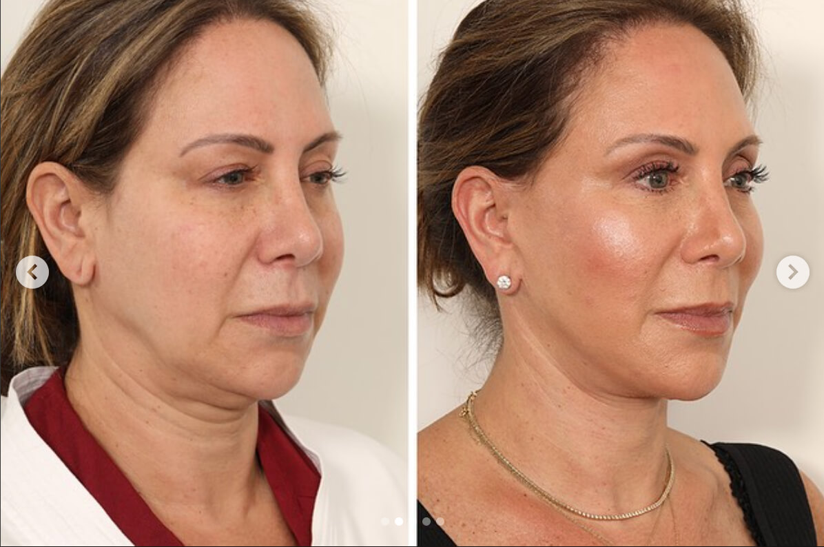 Board Certified Plastic Surgeon Fredericksburg | Dr. Sarah Mitchell MD - Breast Augmentation ...